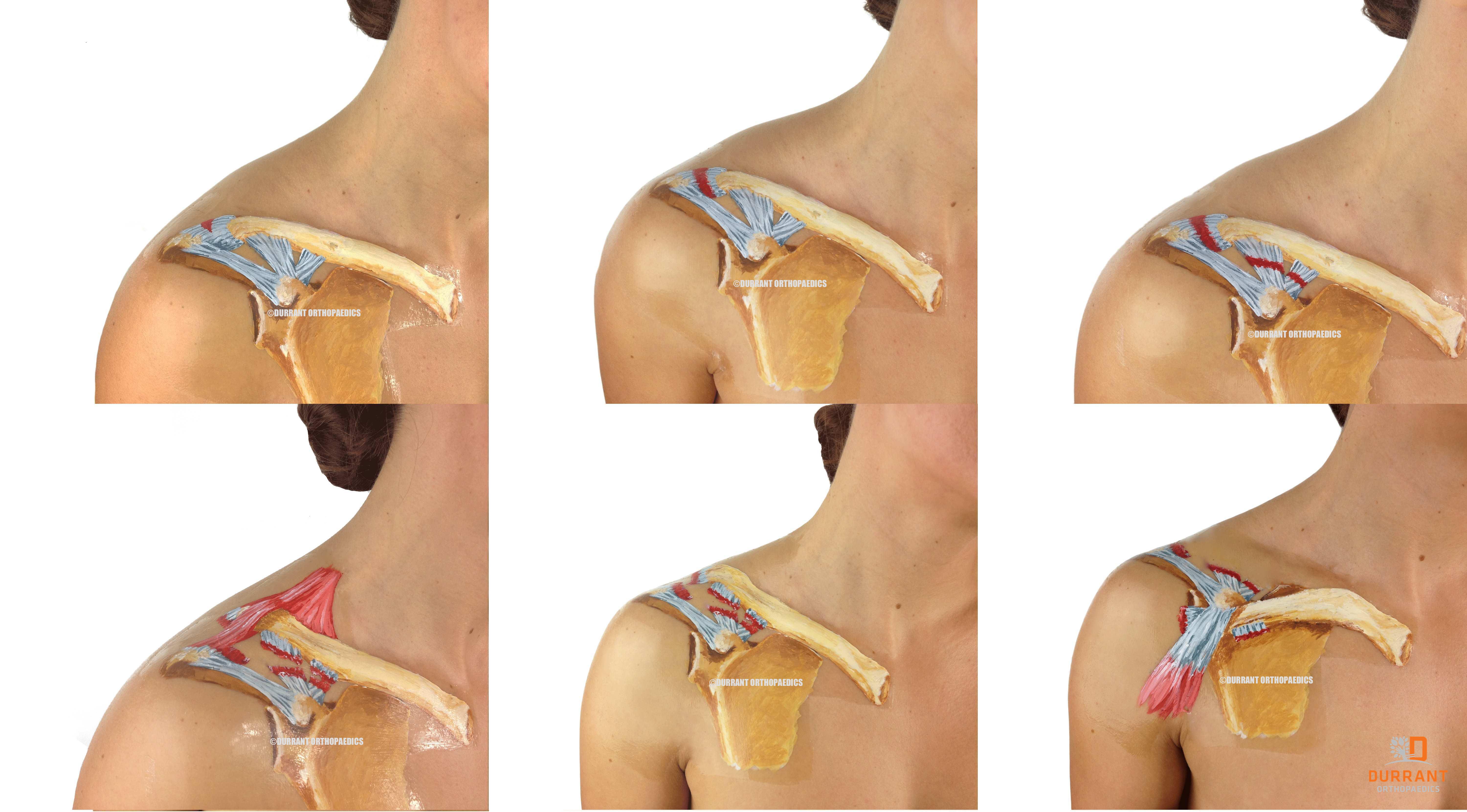 AC Joint Seperations And Injuries A Patients Guide