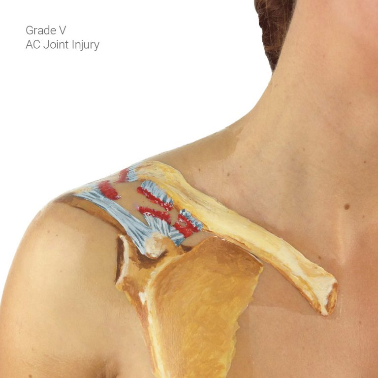 AC Joint Seperations and Injuries a Patients Guide
